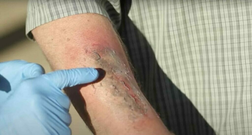 What Happens If You Get Battery Acid On Your Skin Reaction And Safety
